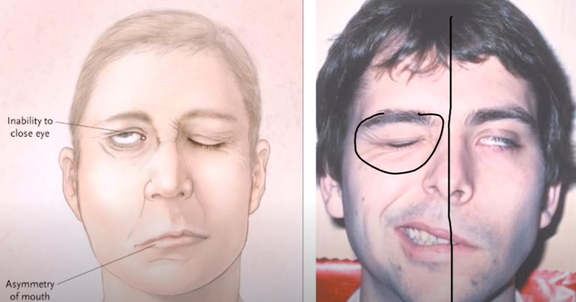 Bellova paraliza | Nova24TV